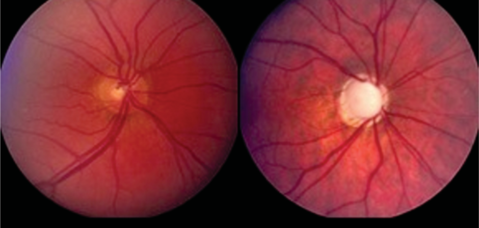 Deep Learning Para La Detección Precoz Del Glaucoma Fundación Seneca
